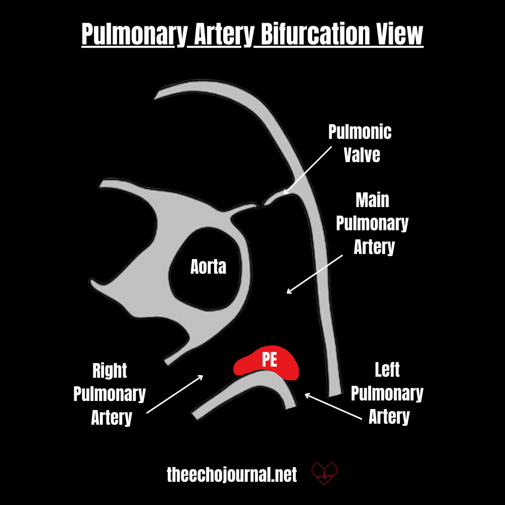Pulmonary Embolism: Types, Case Studies, and the Role of Echocardiography