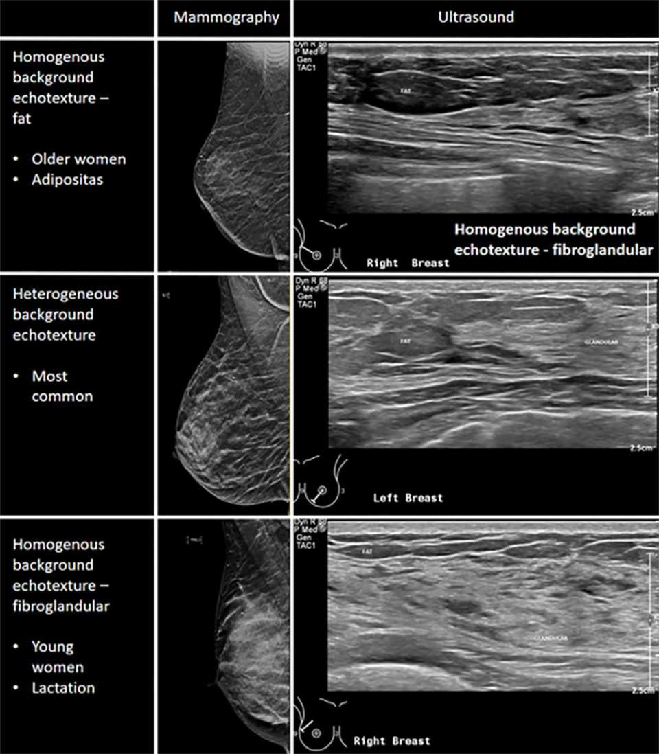 My mammogram says I have dense breasts