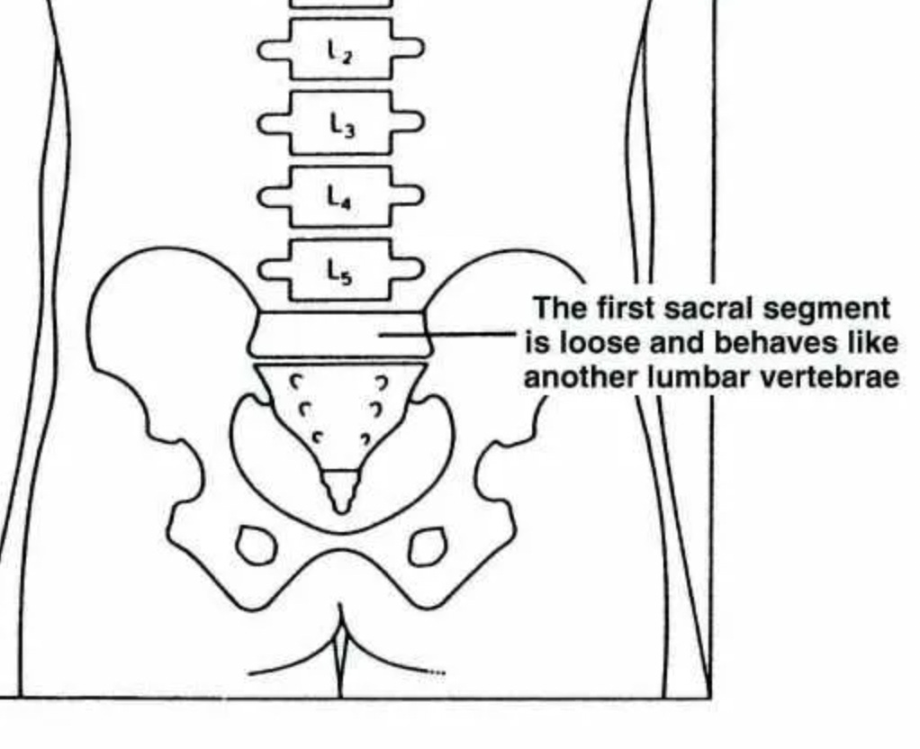 I Have An Extra Vertebra. What Can I Do About it?