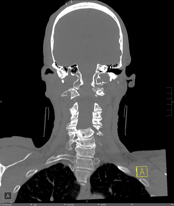 Occipital condyle fracture - by Alexander Baxter - RadNotes
