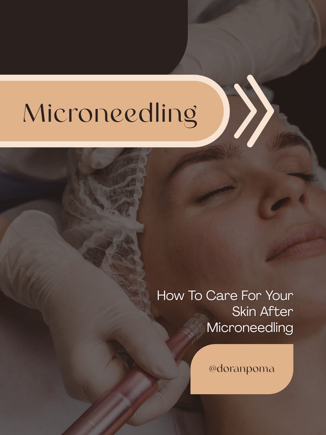 Treatment Guide: Post-Treatment Care After Microneedling