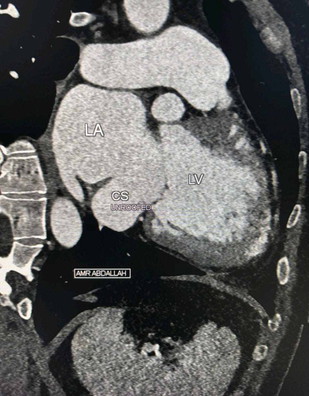 The Fetal Heart and Atrial Septal Defects - by Alex C.