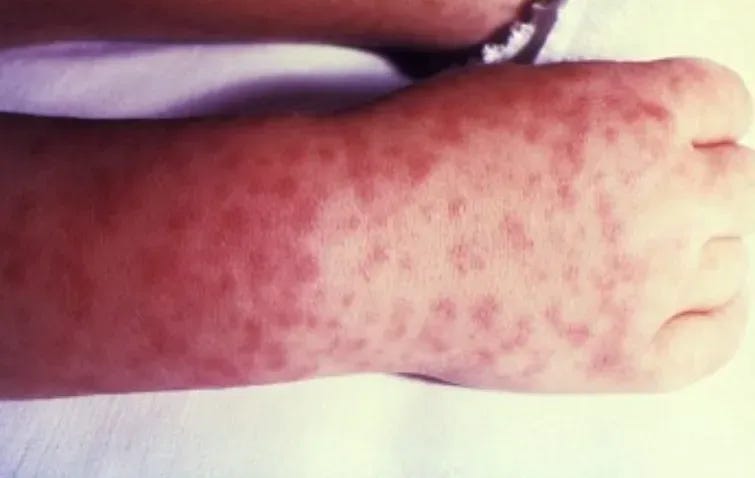 Rocky Mountain Spotted Fever in northern Mexico prompts travel warning