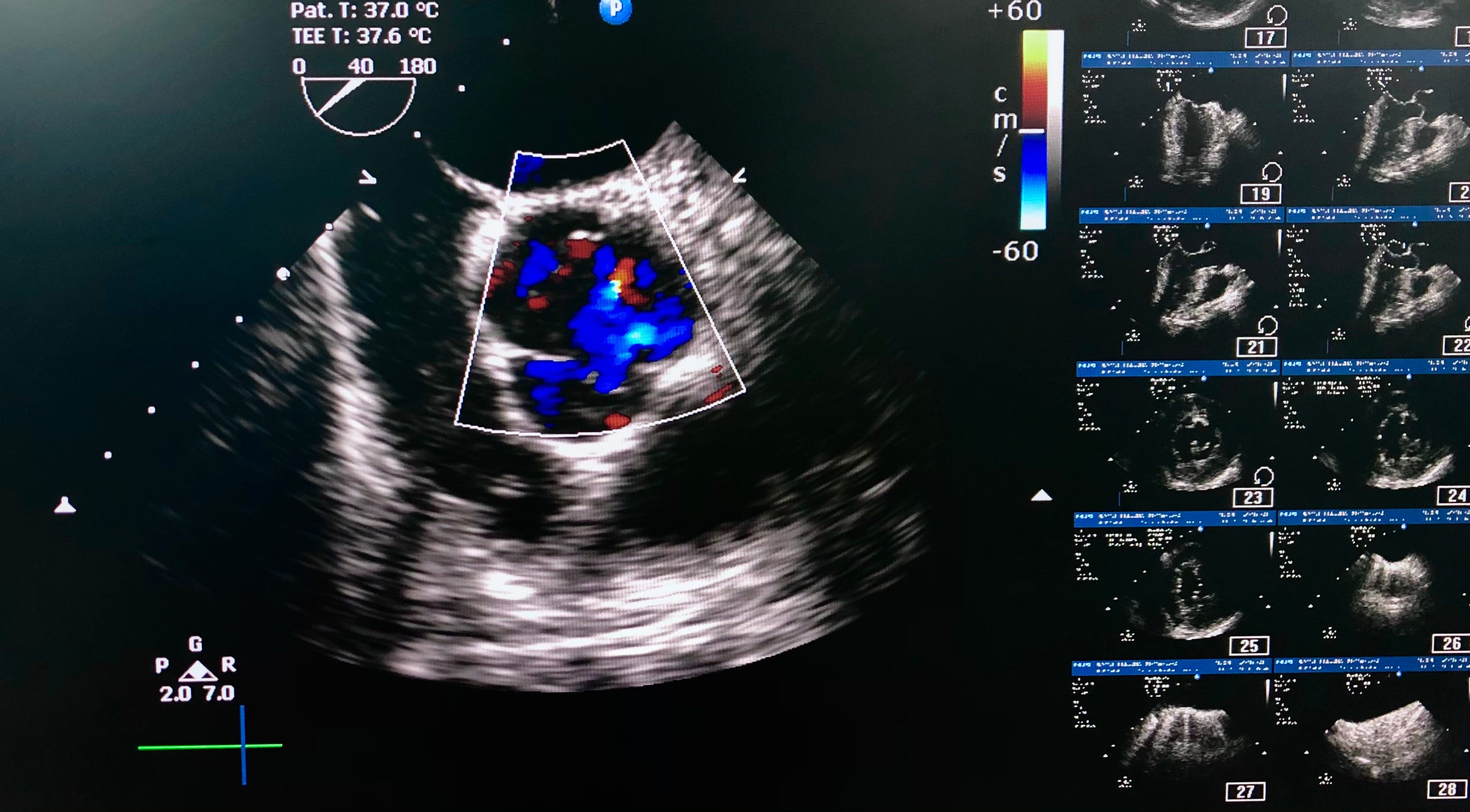 Resuscitative TEE challenges standardized CPR - PulmCCM