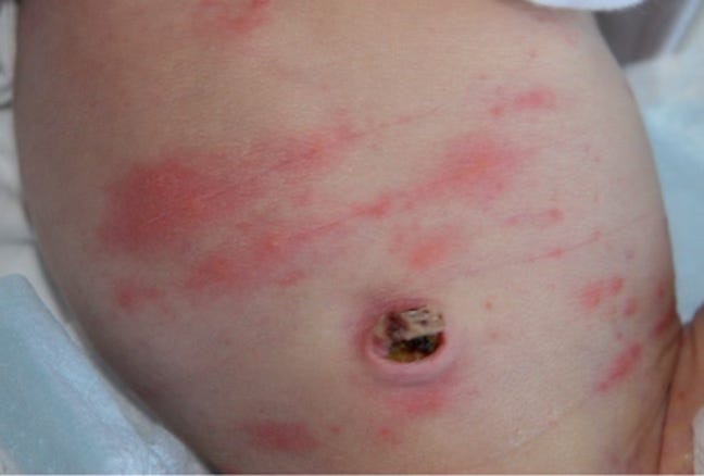 how long does erythema toxicum last on a newborn baby
