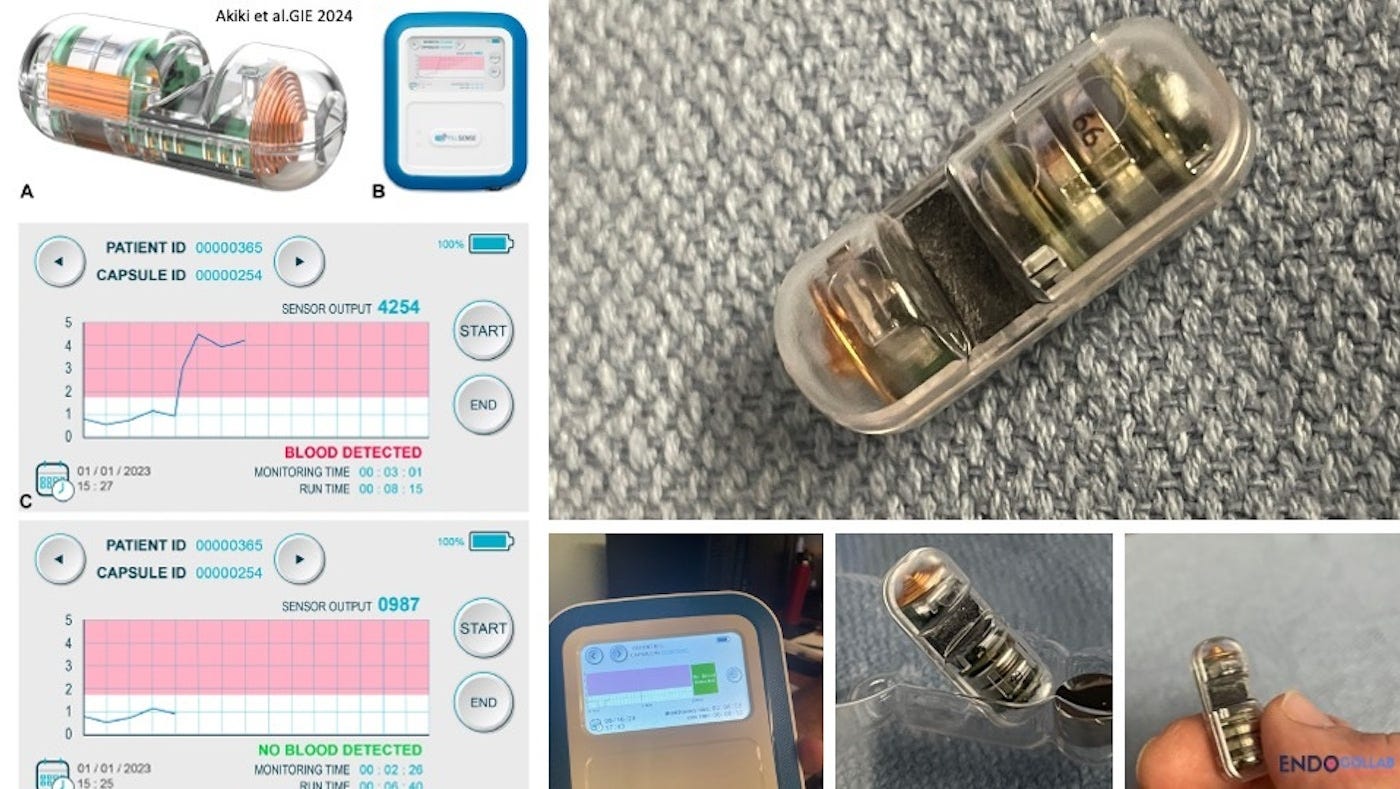 Capsule Device Detects Upper GI Bleeding with High Specificity and ...