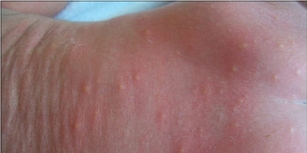 flea bite rash newborn
