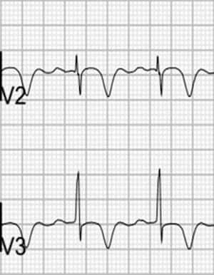 Discussão de ECG: Síndrome de Wellens