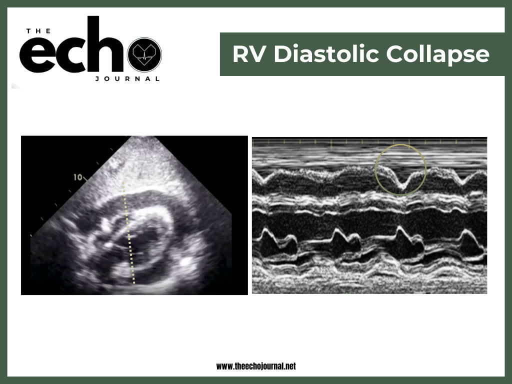 Cardiac Tamponade Echo Rv Collapse