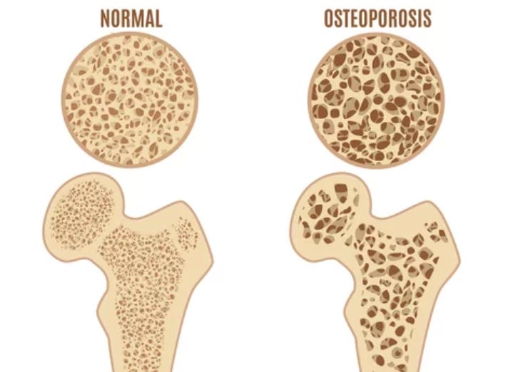 The Role of Bone-Modifying Agents in Breast Cancer