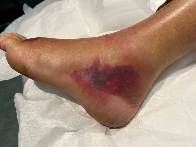 From Flesh Eating Bacteria Explosion to a Rattlesnake Bite. Things You Need to Know!