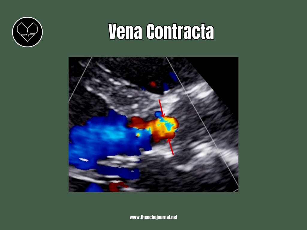Aortic Regurgitation & Color Doppler - Would You Catch These Findings?