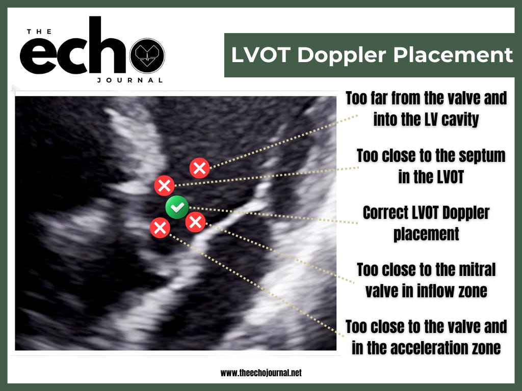6 Continuity Equation Pitfalls Every Sonographer Should Know