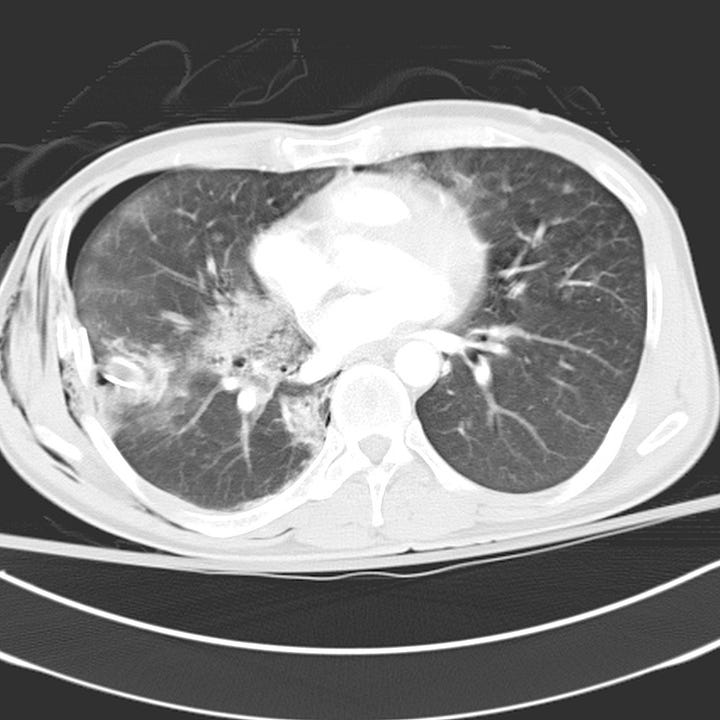 Pulmonary Contusions and Lacerations - by Alexander Baxter