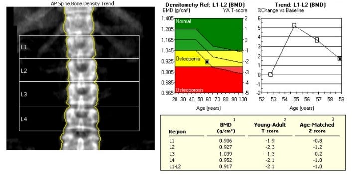 What Your Bone Scan Really Means: Understanding “Significance” in ...