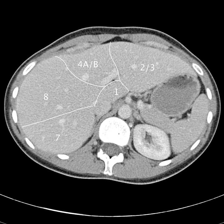 Hepatic segmental anatomy - by Alexander Baxter - RadNotes