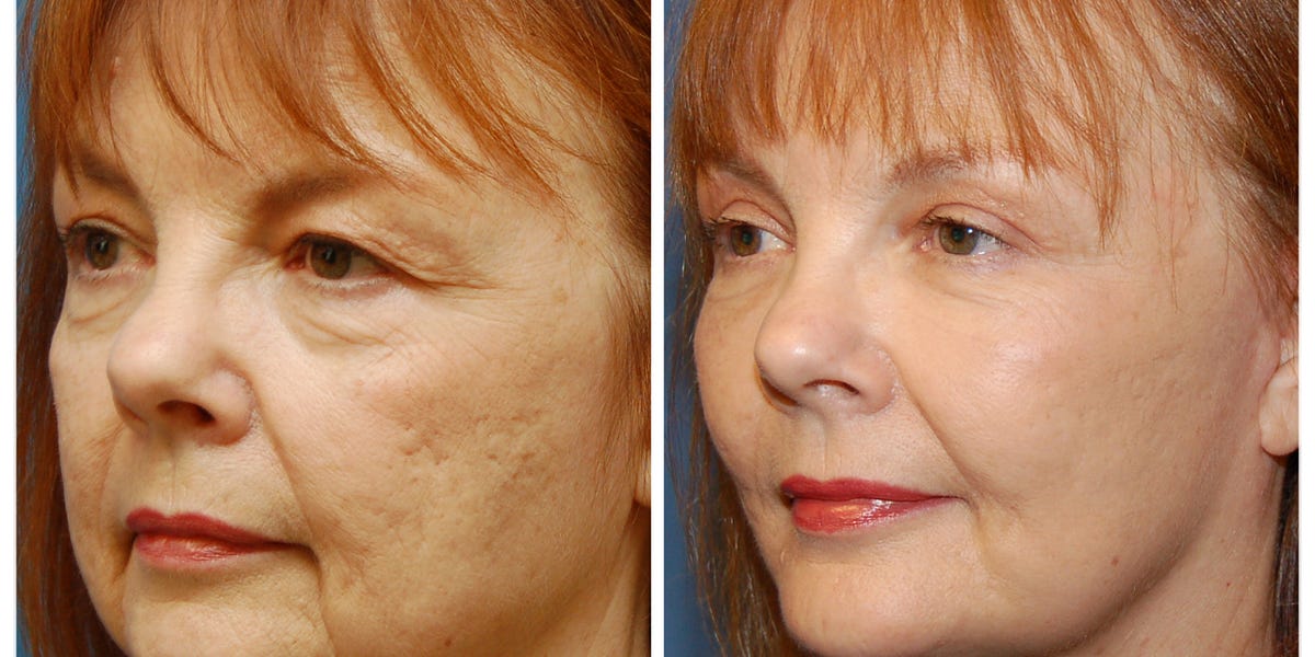 menopause no eyebrows