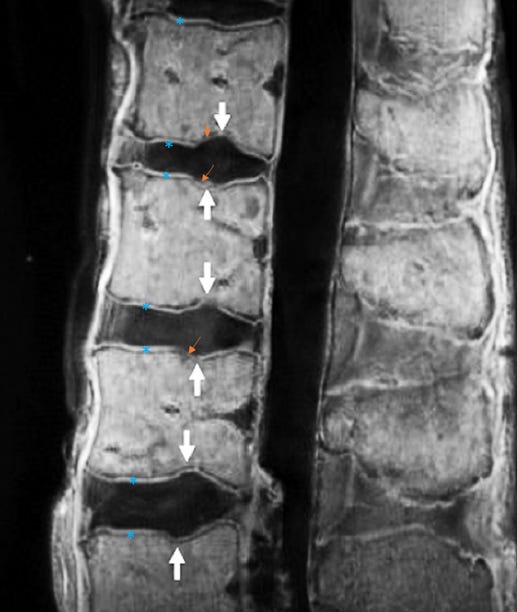Clinician's Corner | Schmorl's Nodes are Puzzling