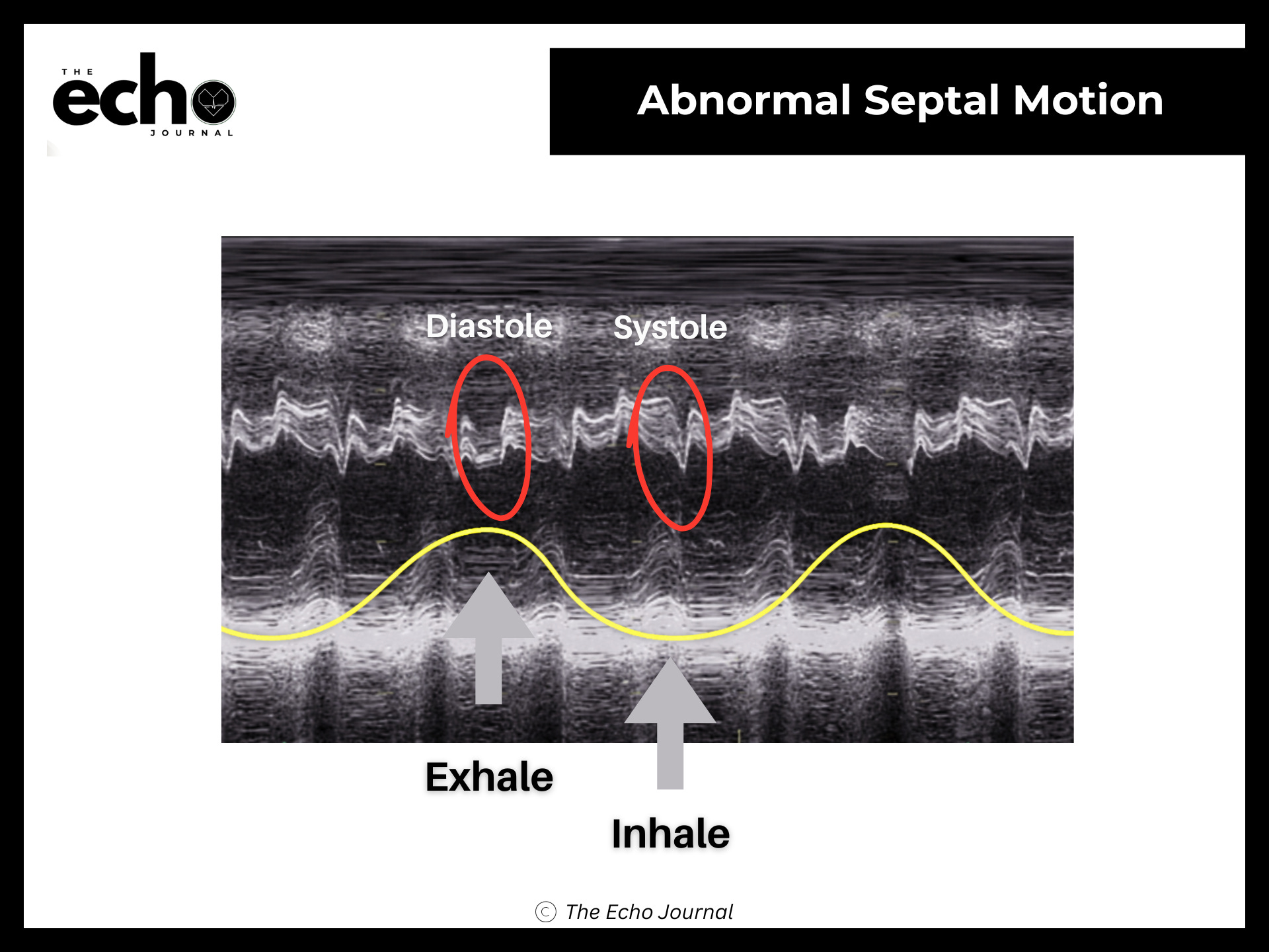 Constrictive Pericarditis: The Echo Findings You Can't Afford to Miss