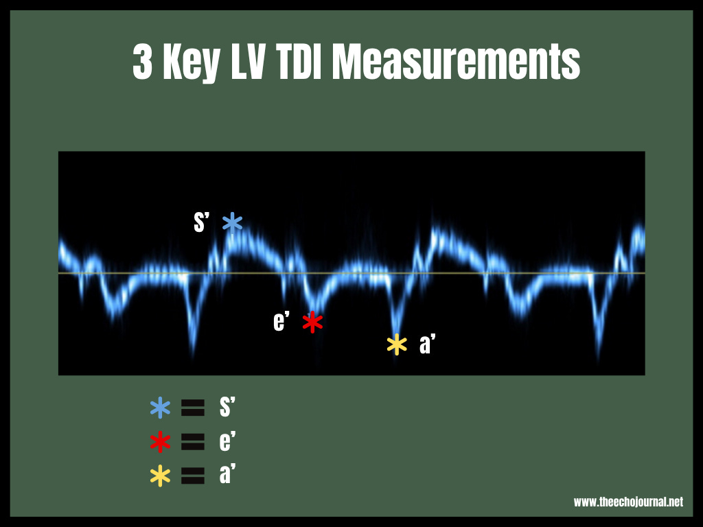 Unlocking Tissue Doppler Imaging: From Setup to Clinical Impact