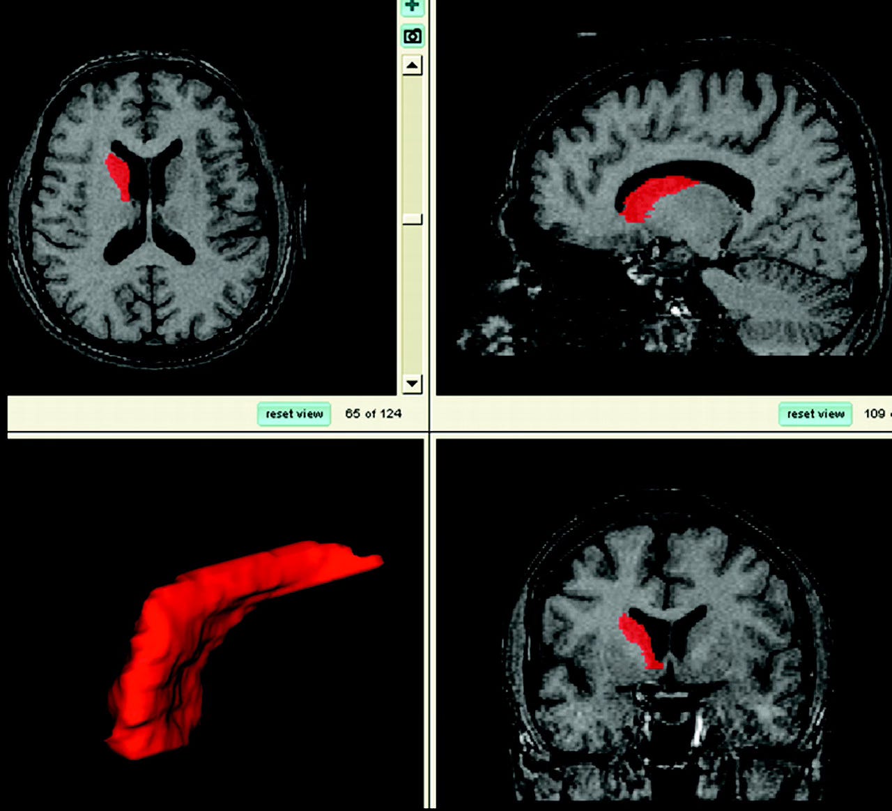 What a New Brain Imaging Study Really Says About Cannabis Use in Older ...