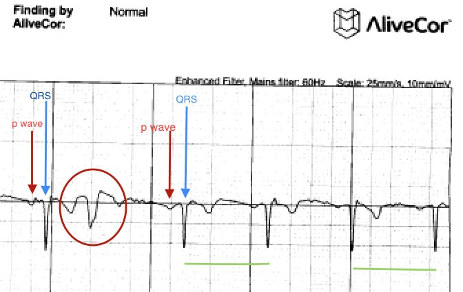 Are Your Palpitations Due to Benign Premature Ventricular Contractions ...