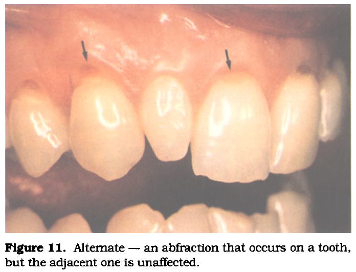 Abfractions: A New Classification of Hard Tissue Lesions of Teeth