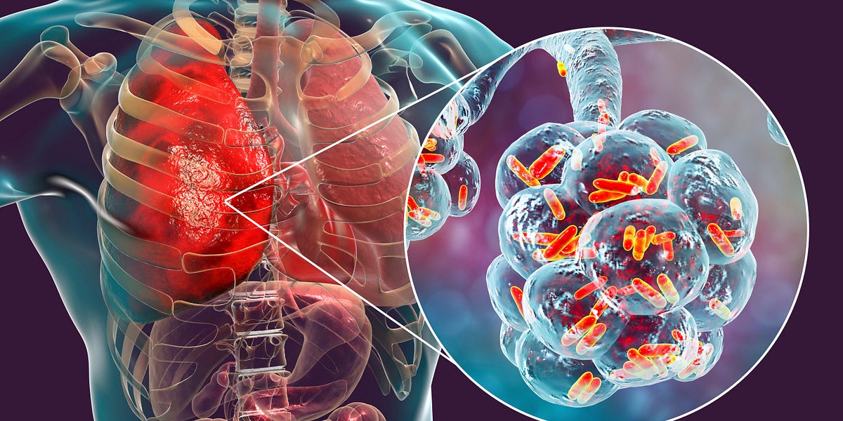 Corticosteroids for community-acquired pneumonia (CAPE COD trial)