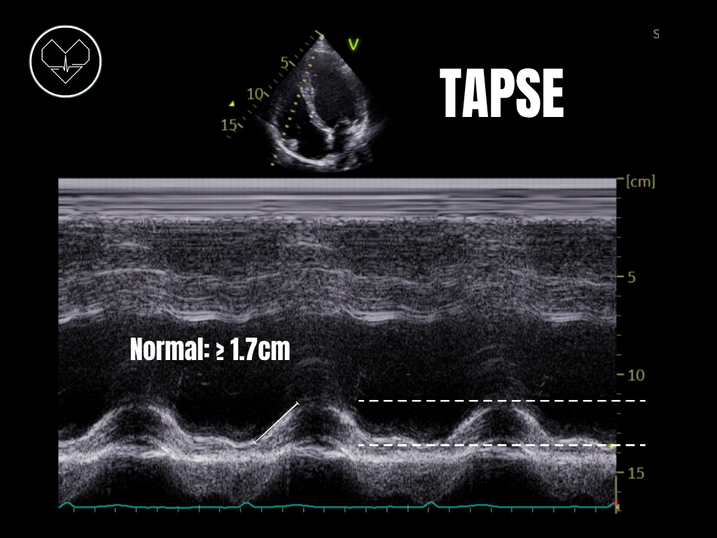 Cor Pulmonale on Echo: What Sonographers Need to Know