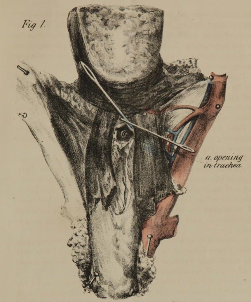Case of Croup. (Death by Traumatic Hemorrhage.)