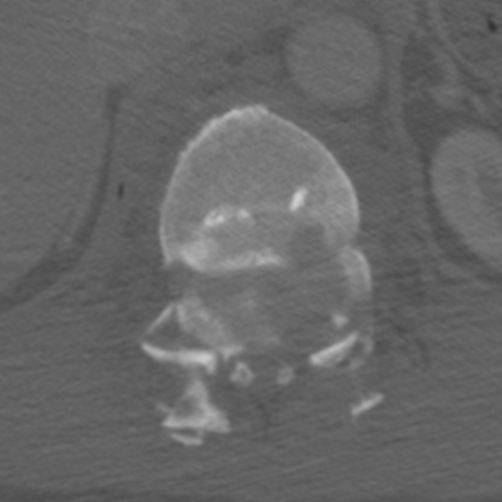 Spinal distraction injuries and dislocation