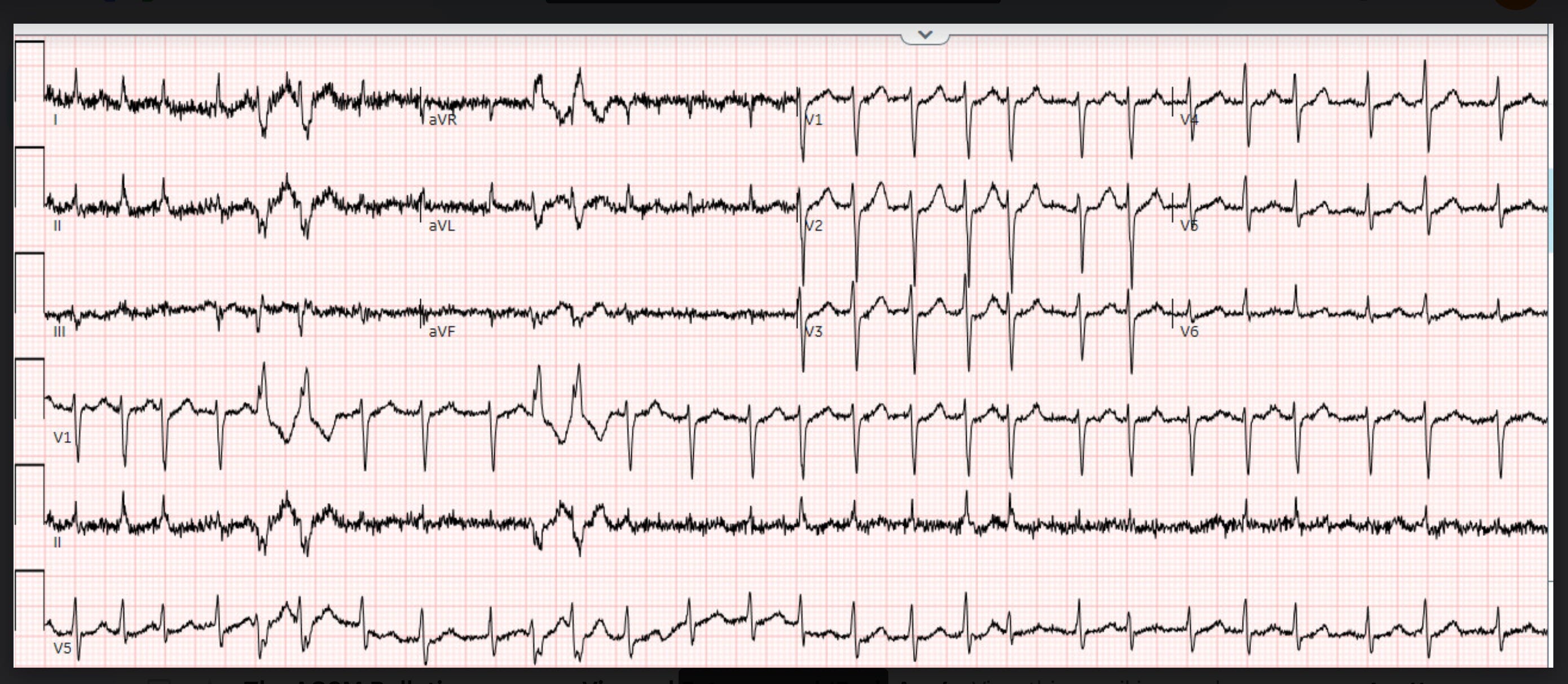 Atrial Fibrillation with a Rapid Ventricular Response Can Mimic VT