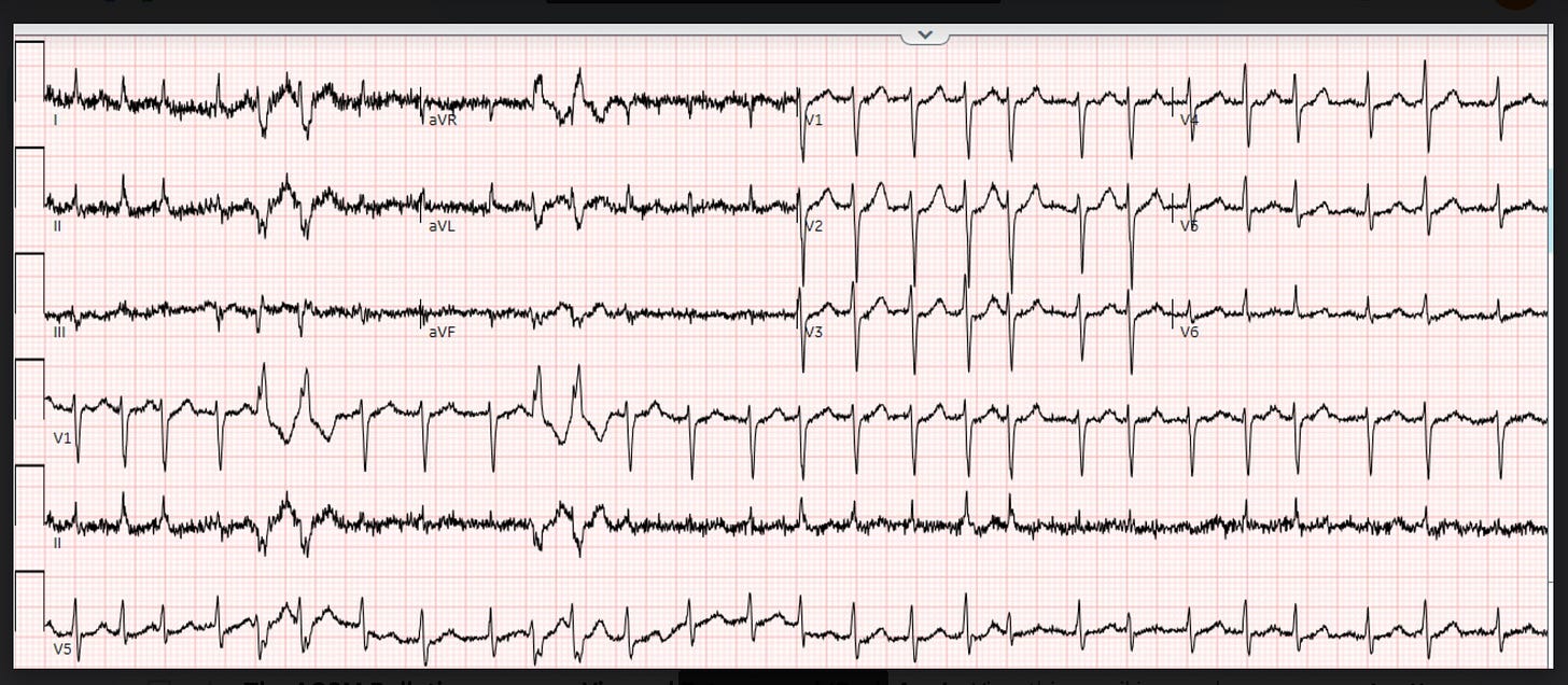 Atrial Fibrillation with a Rapid Ventricular Response Can Mimic VT