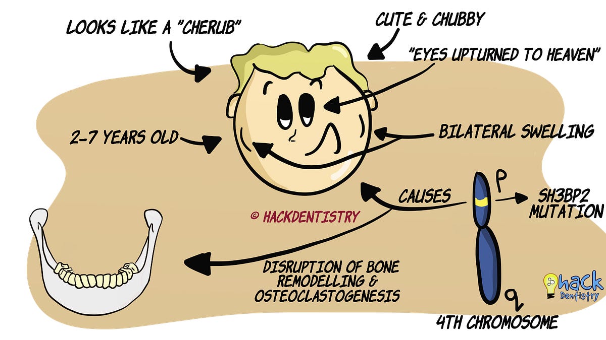 cherubism causes