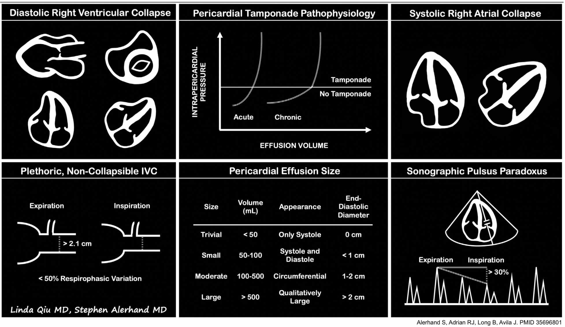 Cardiac Tamponade (Part 1) - by Arman Hussain