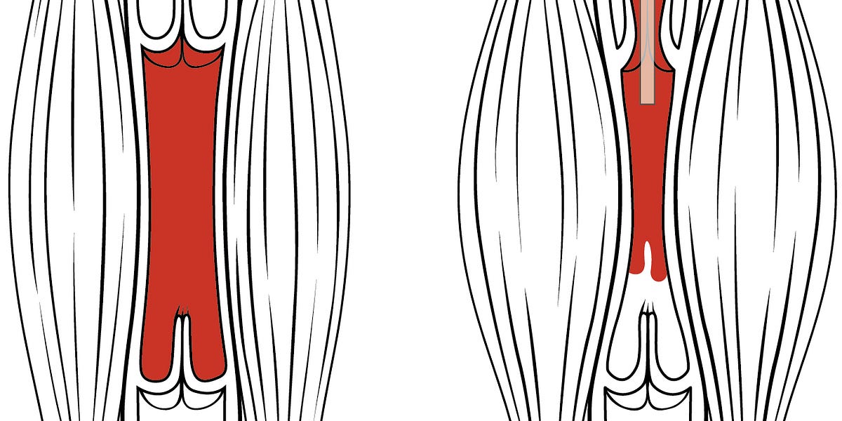 Case study - feet swelling - by Gavin Giovannoni