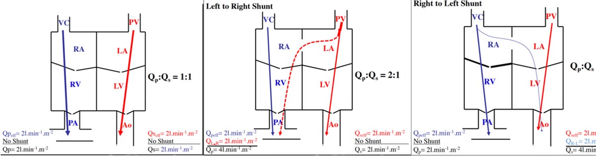 cardiac shunt study