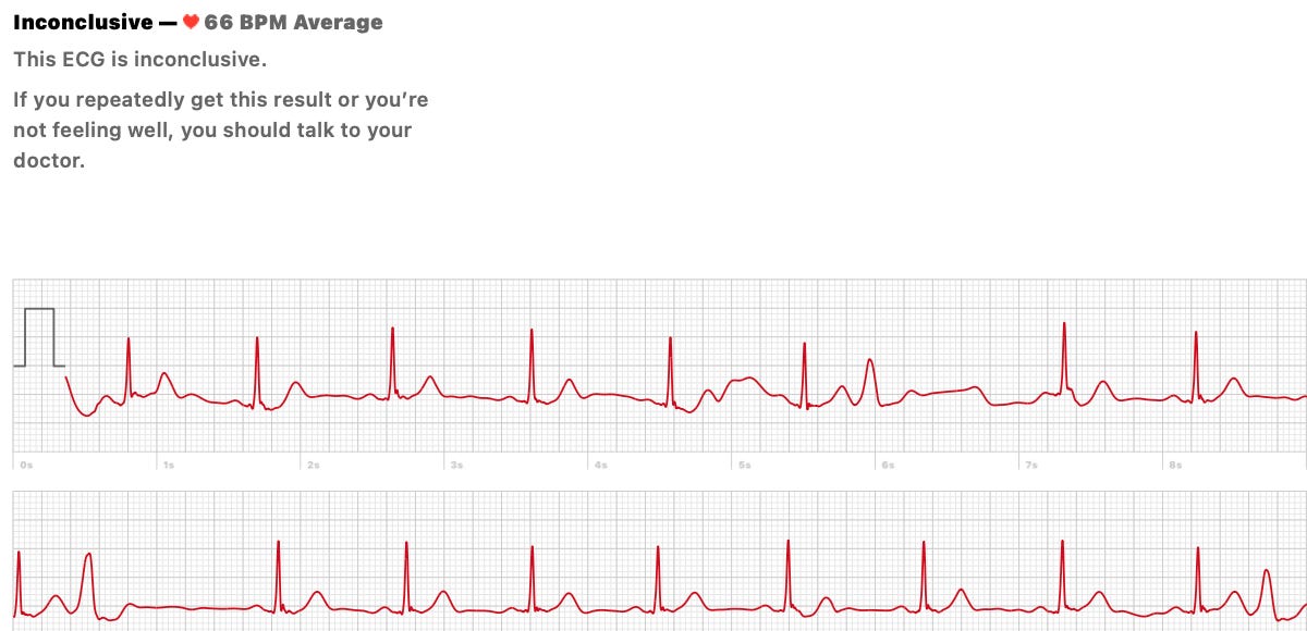 Unlocking the Crucial Cardiac Information Hiding Within Your Smartwatch ...