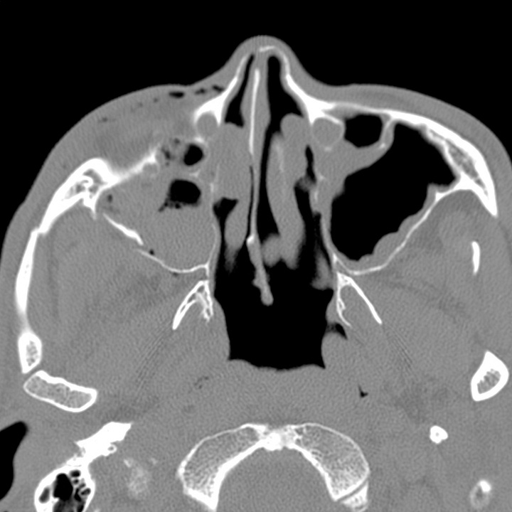 Zygomaticomaxillary Complex Fracture - RadNotes