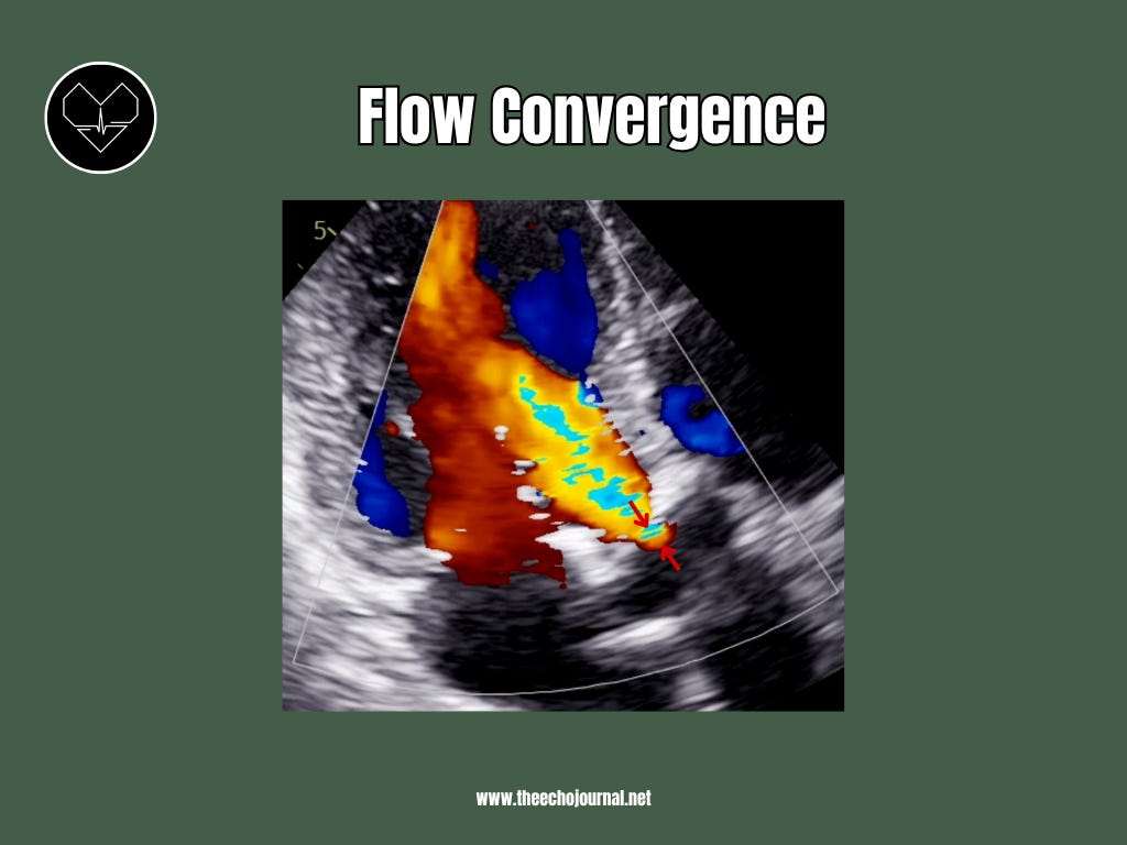 Aortic Regurgitation & Color Doppler - Would You Catch These Findings?