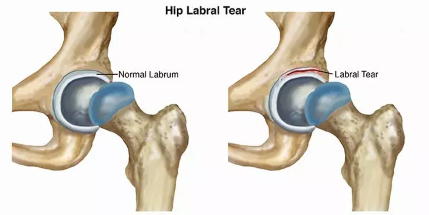 Hip Labral Tear Rehabilitation - by Dr. Tom Walters
