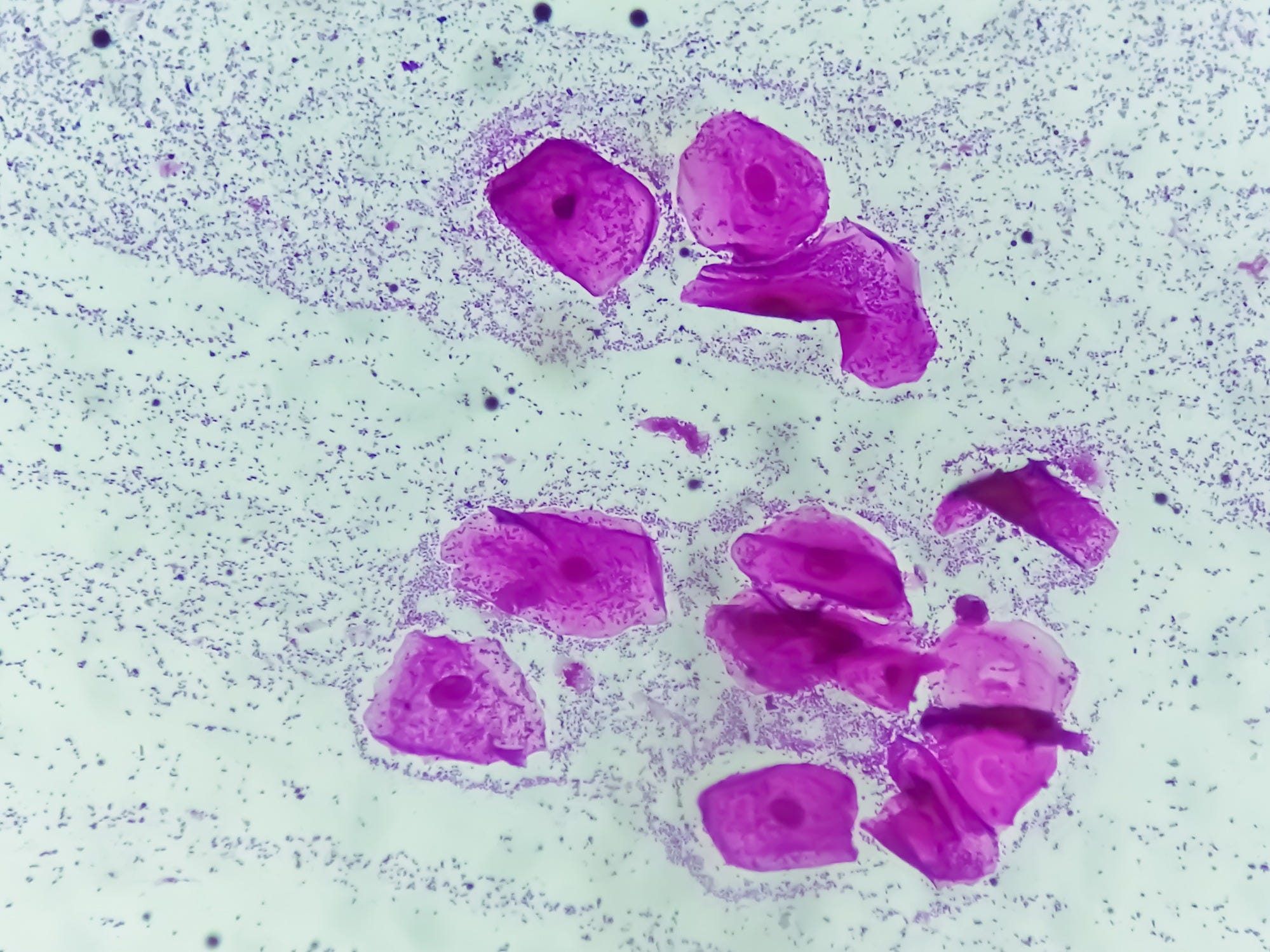 Bacterial Vaginosis - The Era of Treating Male Partners Has Arrived