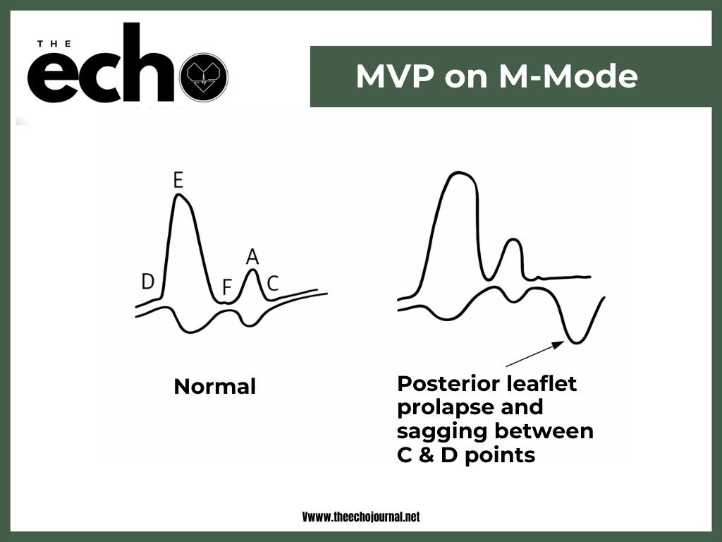 M-Mode Echocardiography: The “Outdated” Tool You’re Probably Underusing