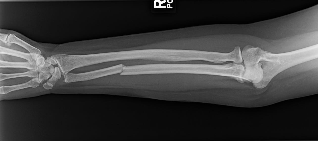 Forearm fractures - by Alexander Baxter - RadNotes
