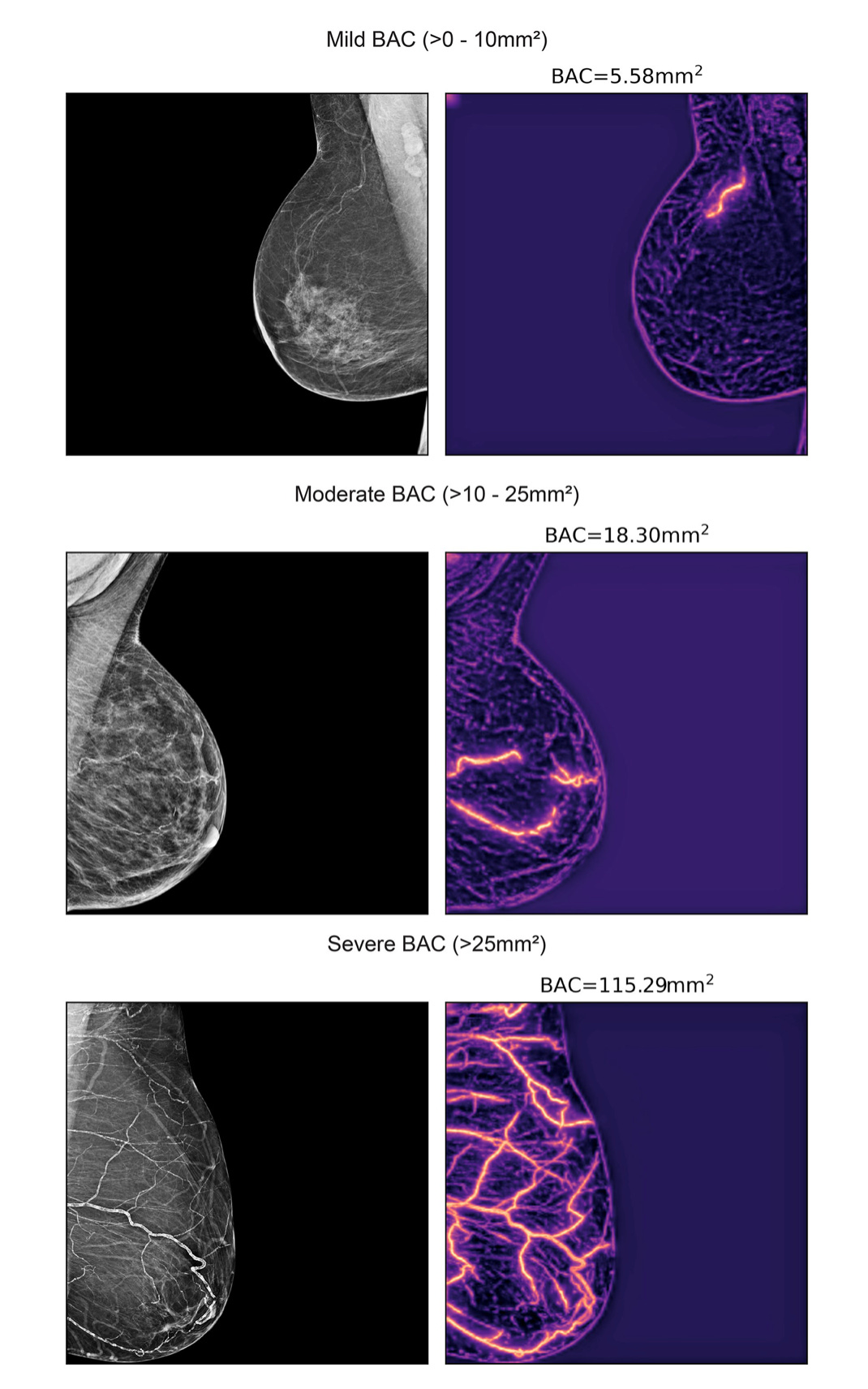 What mammograms know… about the heart?