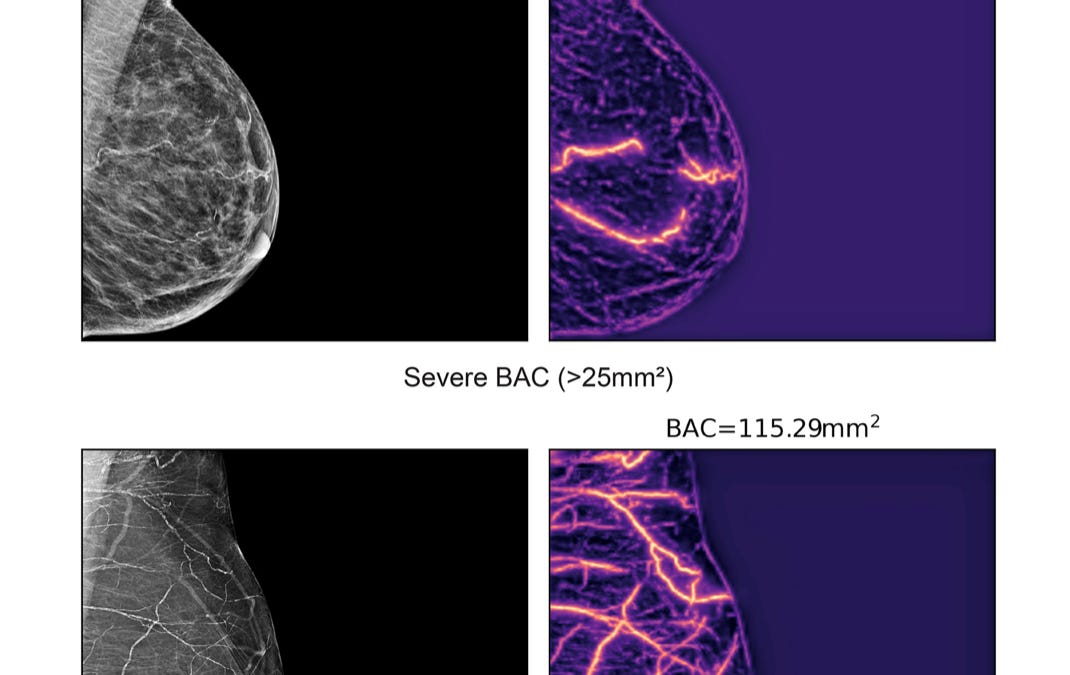 What mammograms know… about the heart?