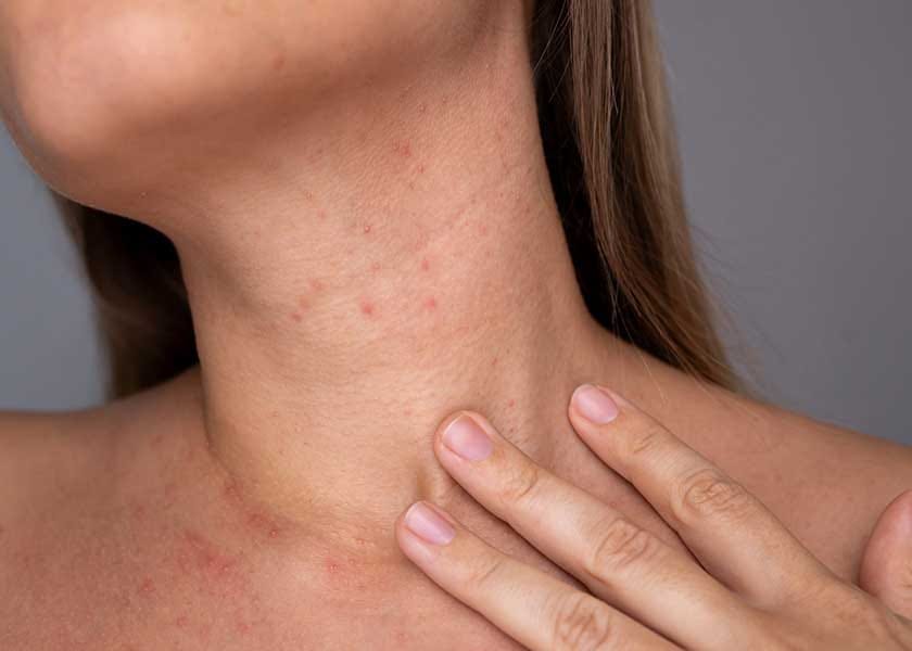 Could Hormone-Disrupting Chemicals Be Behind Your Skin Problems?