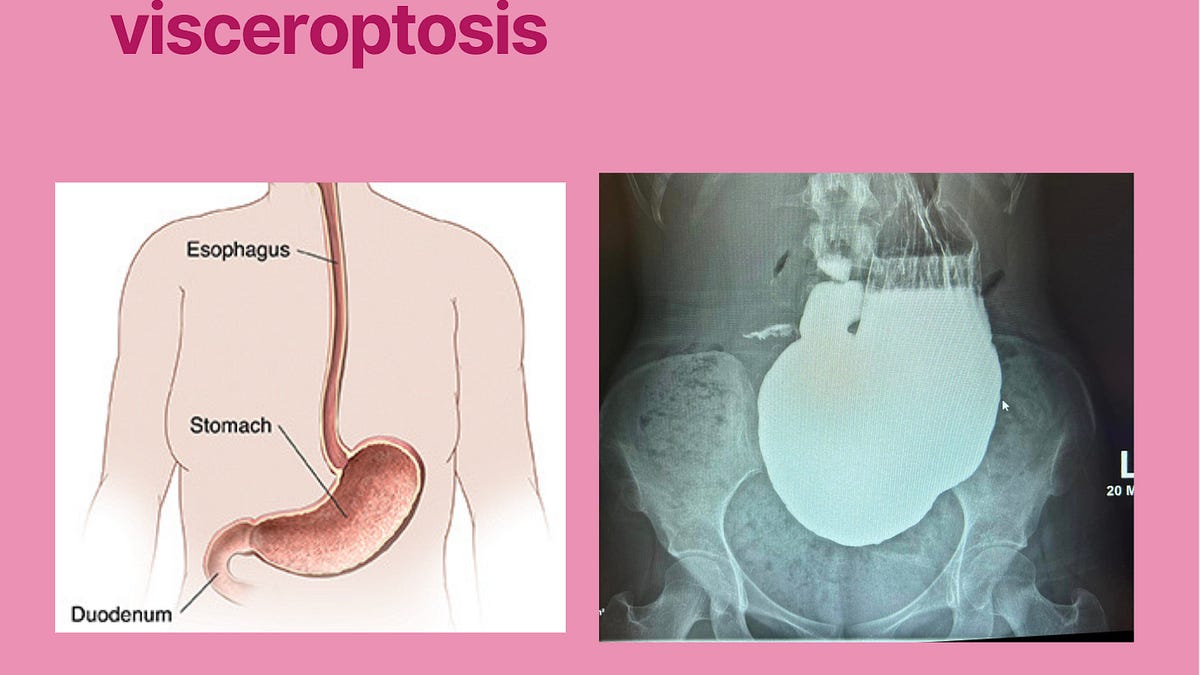 Visceroptosis and Hypermobile Ehlers-Danlos Syndrome