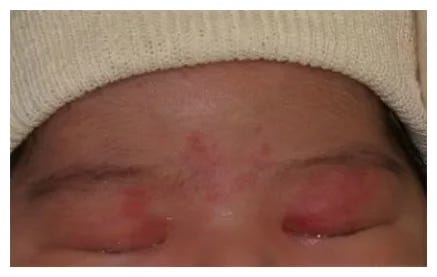 nevus simplex