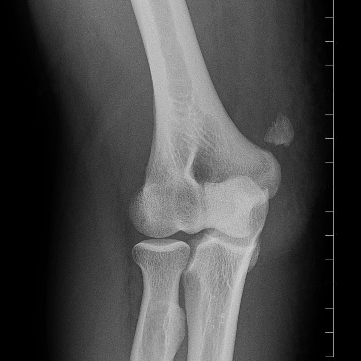 Olecranon fracture and triceps avulsion